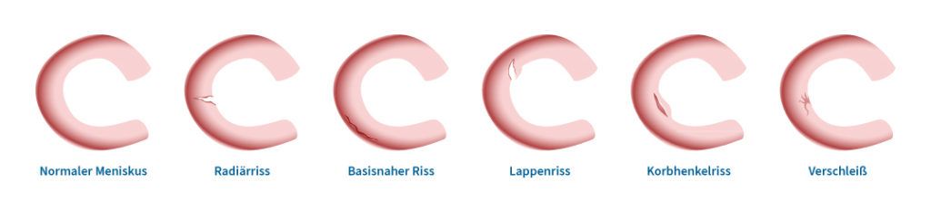 Meniskusriss: Die Verletzung im Überblick